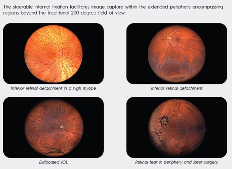 Cellview Imaging - WRI-1 Retinal Imager - Essilor Instruments USA